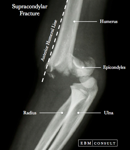 Supracondylar Fracture - General Review